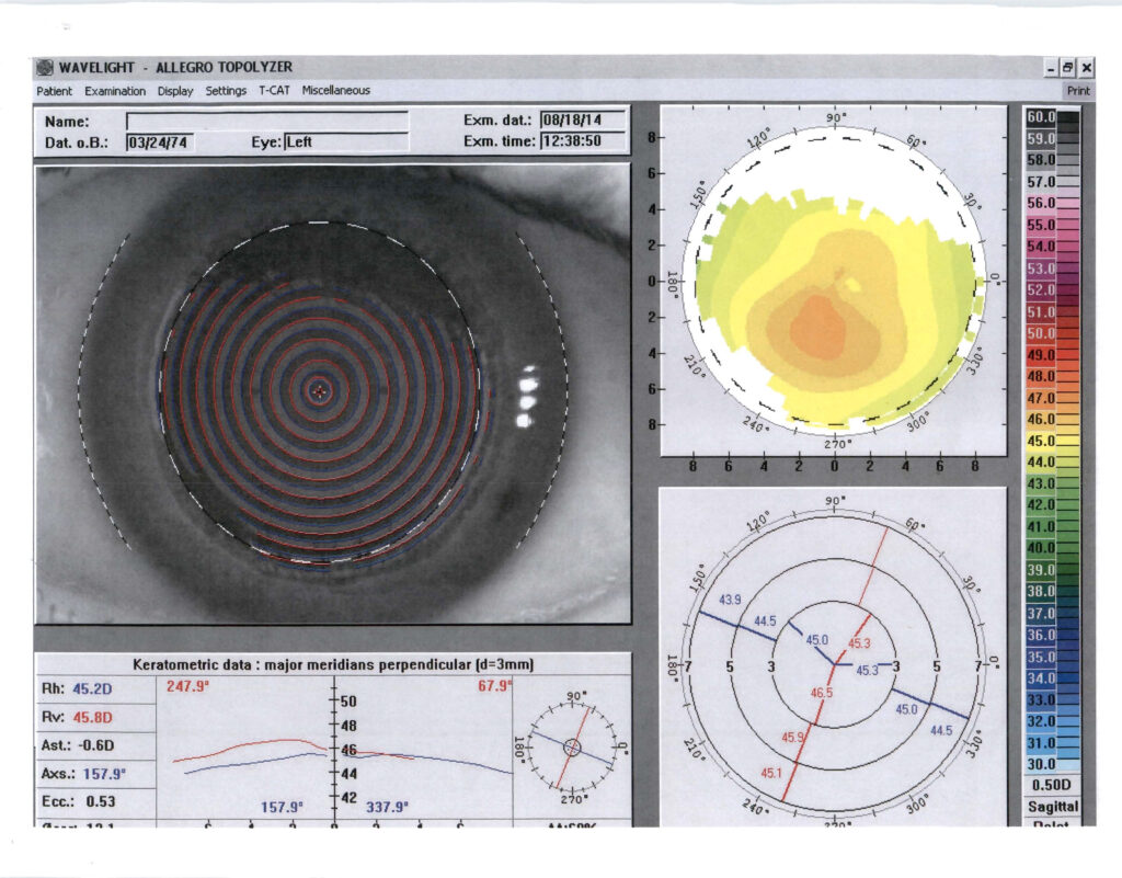 Tests & Diagnostics - Memorial Eye Institute - LASIK Harrisburg