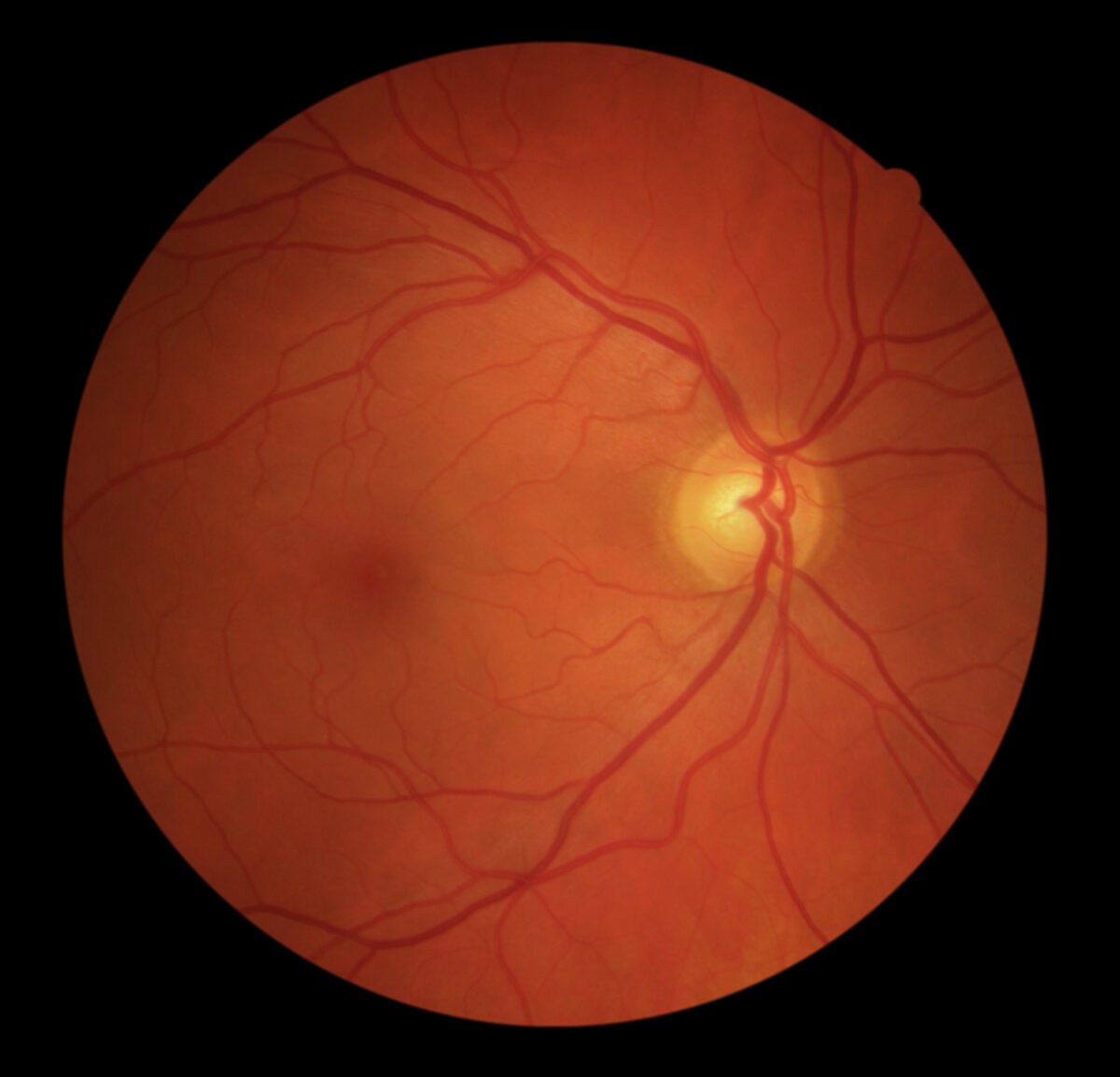 Tests & Diagnostics - Memorial Eye Institute - LASIK Harrisburg